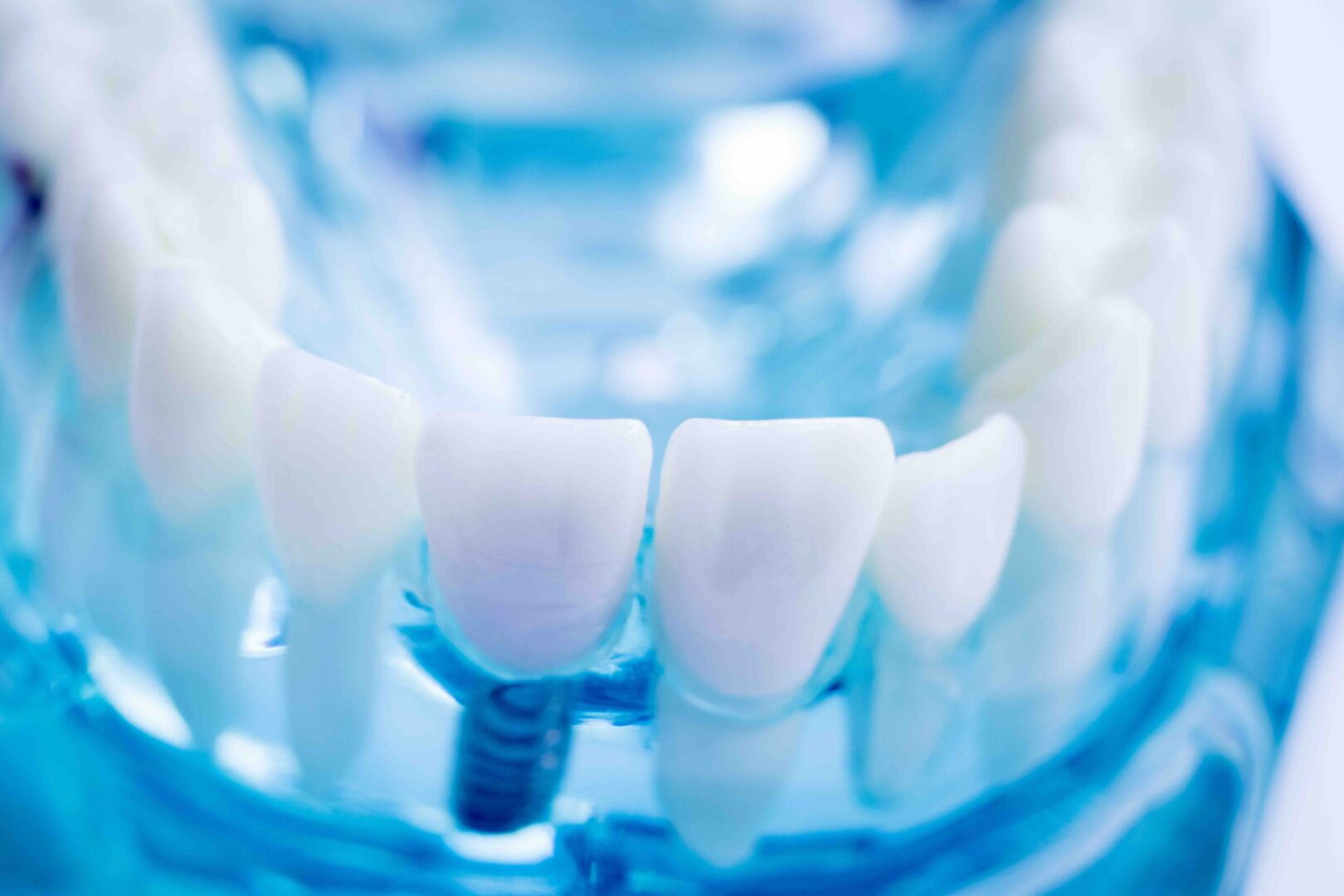 Cosa Mangiare Dopo Un Impianto Dentale: Guida Al Recupero | Medicenter